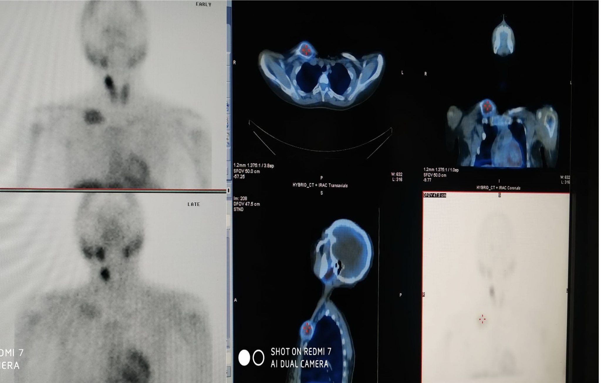 Endocrinology 2 - Asian Nuclear Medicine Board (ANMB)